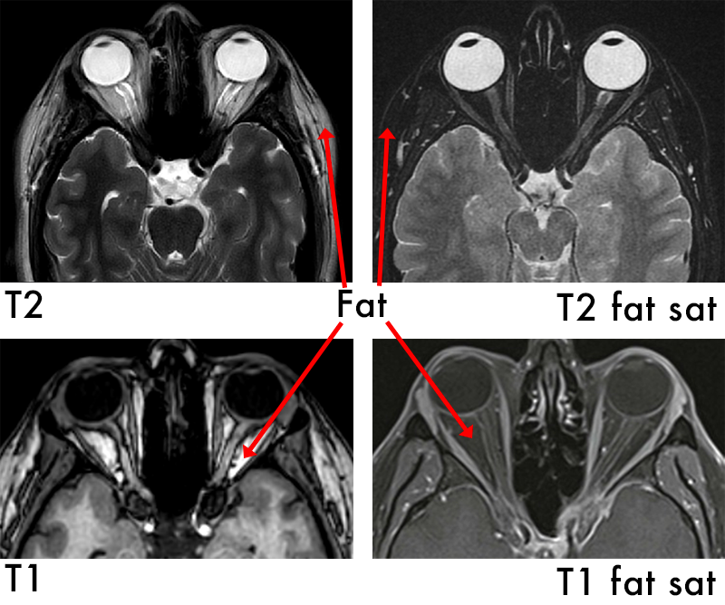 What is fat saturation?