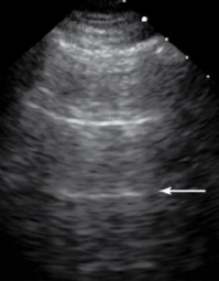Common Ultrasound Artifacts