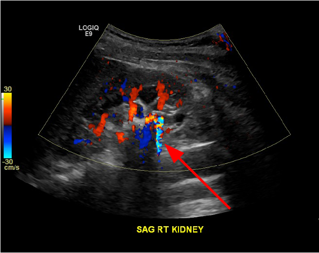 Common Ultrasound Artifacts